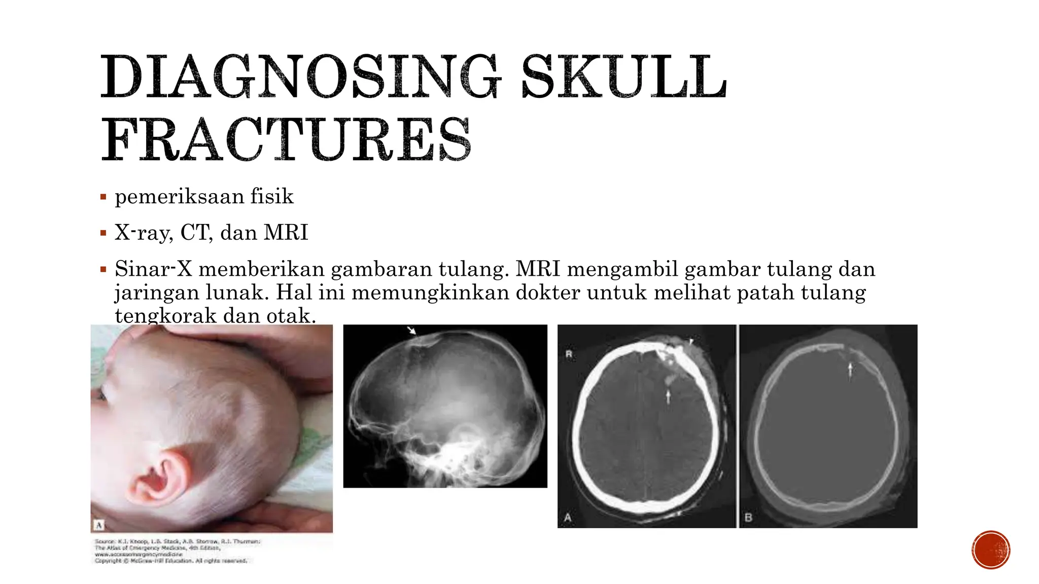Depressed Fracture of the skull in trauma.pptx