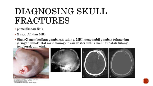 Depressed Fracture of the skull in trauma.pptx
