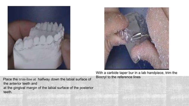Deprogramming spilnt 1 | PPTX | Dental Health | Diseases and Conditions