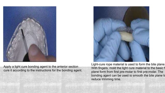 Deprogramming spilnt 1 | PPTX | Dental Health | Diseases and Conditions