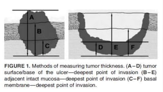 Depth of invasion in oral squamous cell carcinoma | PPT