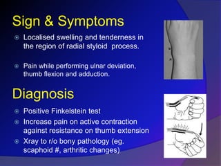 De quervain's | PPTX