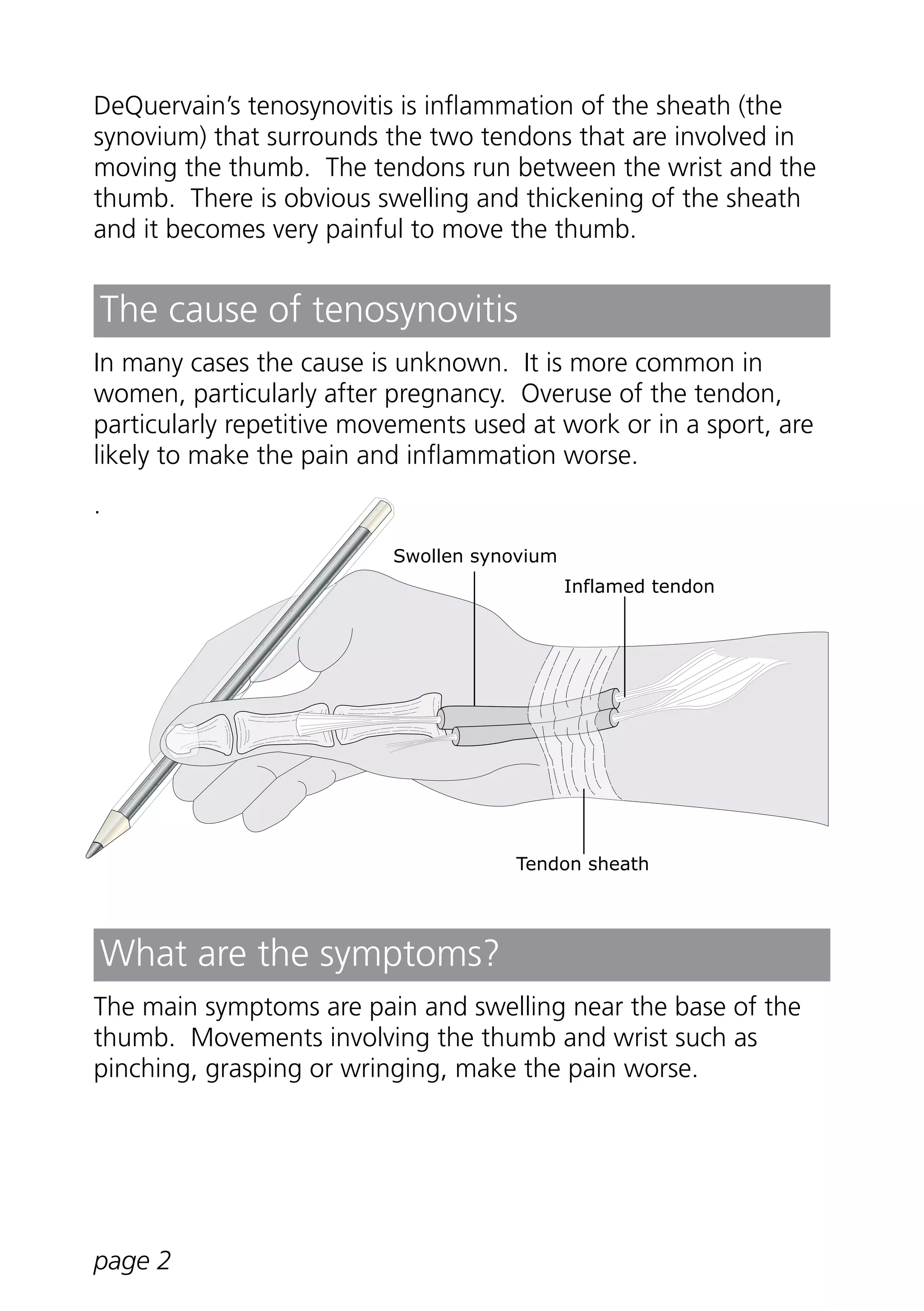 De quervain's tenosynovitis | PDF