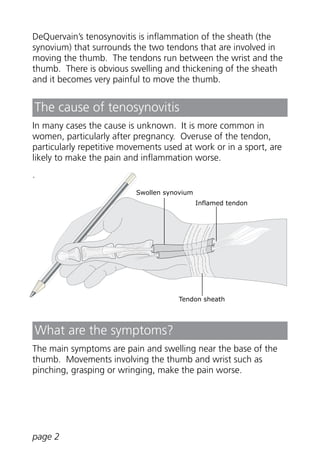 De quervain's tenosynovitis | PDF