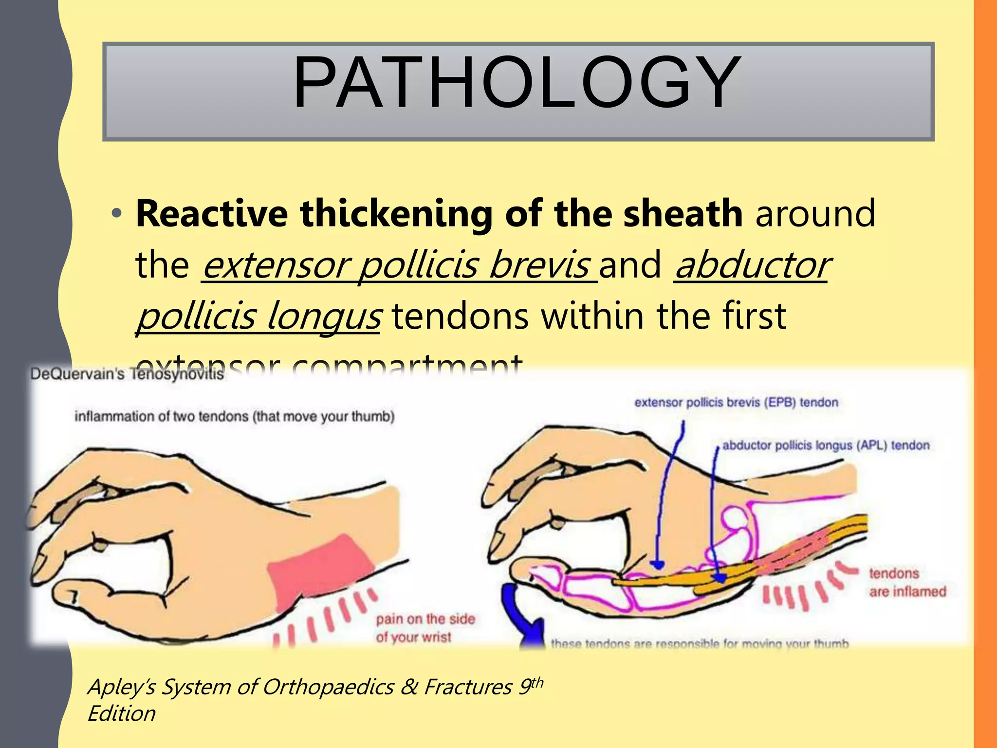 Dequervain's Tenosynovitis23.pptx
