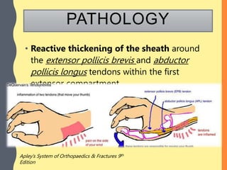 Dequervain's Tenosynovitis23.pptx