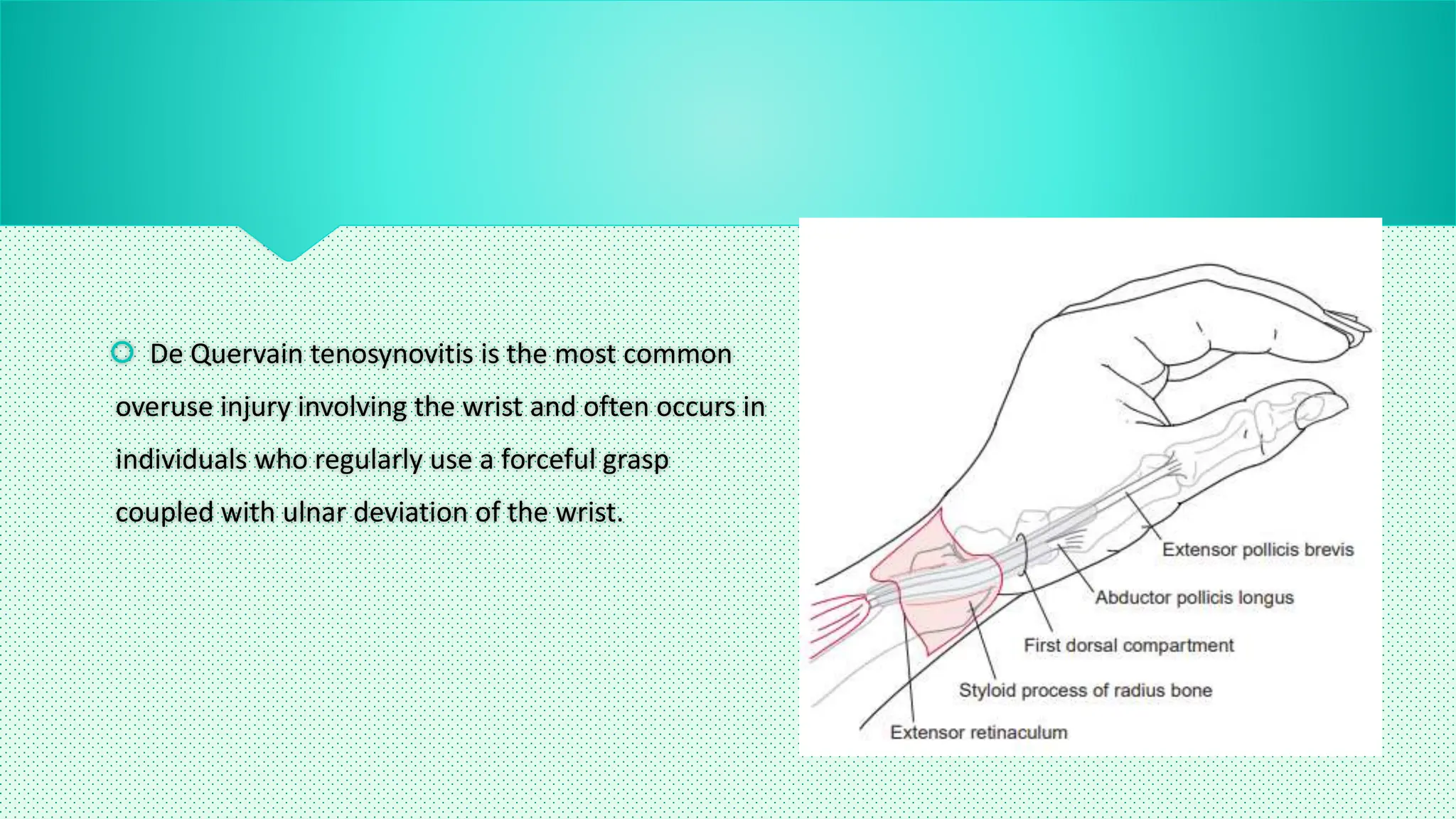 De-quervain tenosynovitis- PHYSIOTHERAPY | PPTX