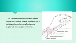 De-quervain tenosynovitis- PHYSIOTHERAPY | PPTX