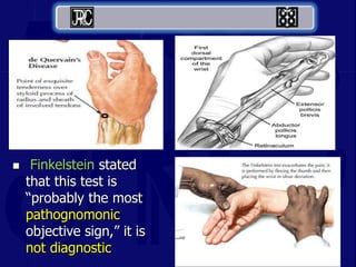 Dequrvain syndrom | PPT