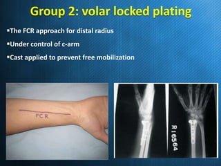 External fixation versus volar locking plate for displaced intra ...