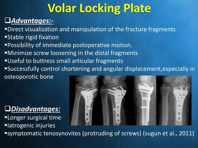 External fixation versus volar locking plate for displaced intra ...