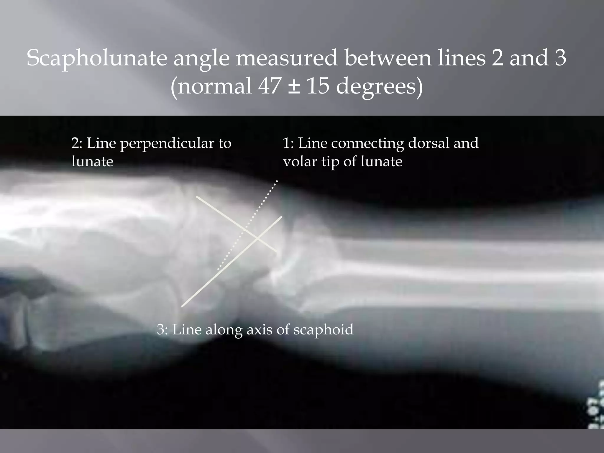 DISTAL END RADIUS FRACTURE | PPTX