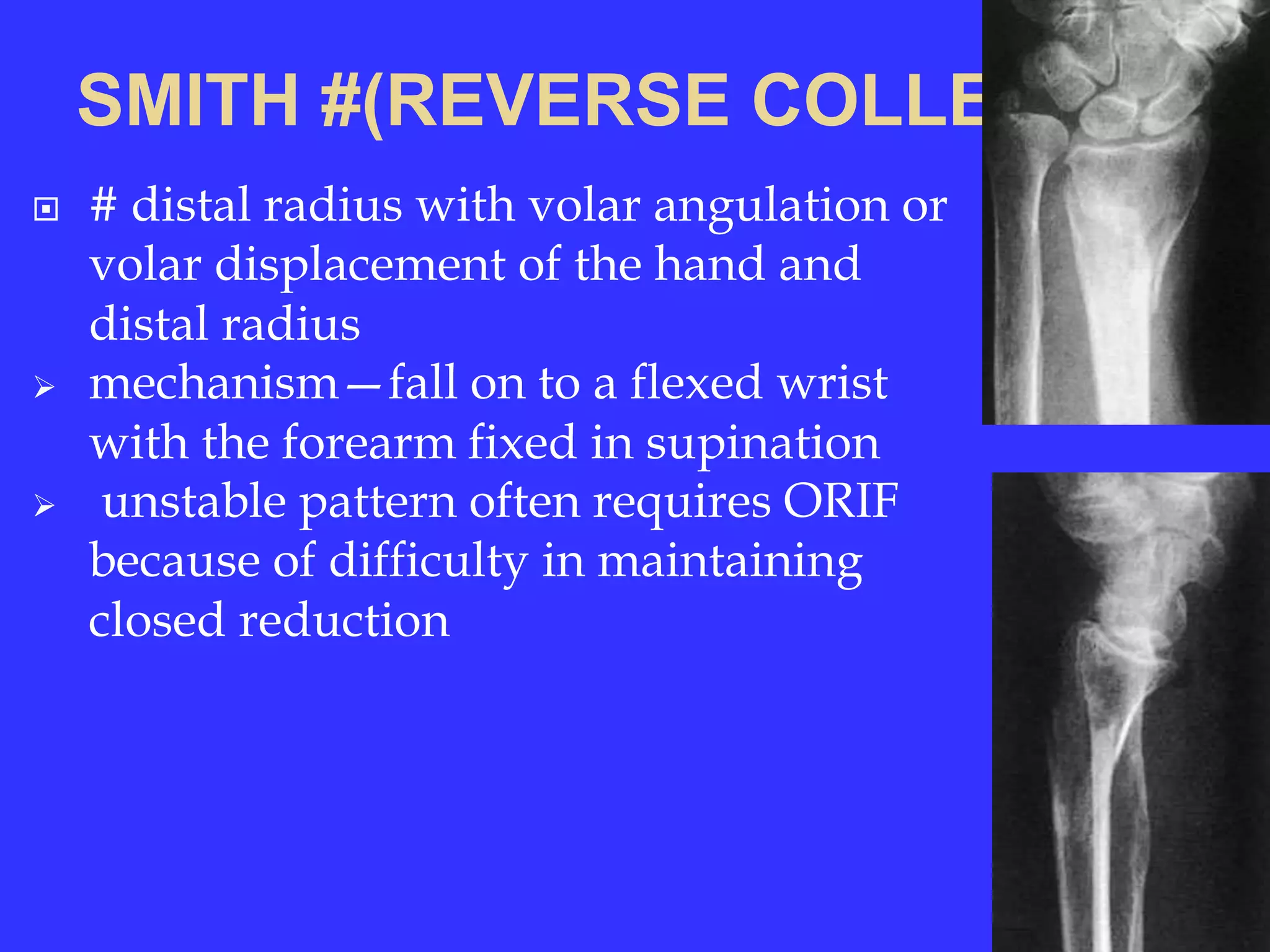 DISTAL END RADIUS FRACTURE | PPTX