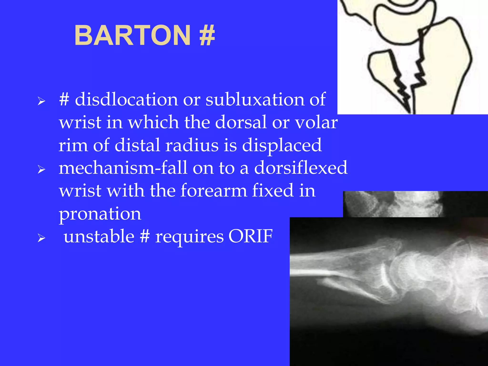 DISTAL END RADIUS FRACTURE | PPTX
