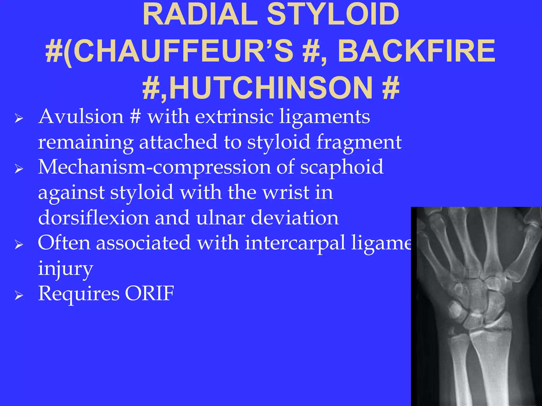 DISTAL END RADIUS FRACTURE | PPTX