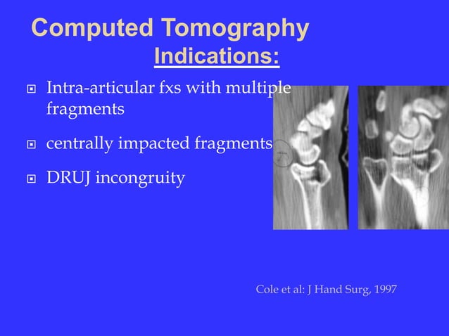 DISTAL END RADIUS FRACTURE | PPTX