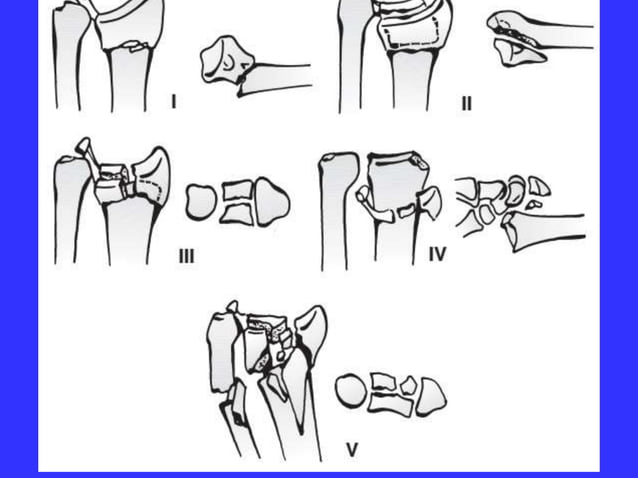DISTAL END RADIUS FRACTURE | PPTX