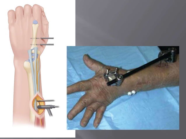 DISTAL END RADIUS FRACTURE | PPTX