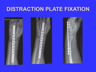 DISTAL END RADIUS FRACTURE | PPTX