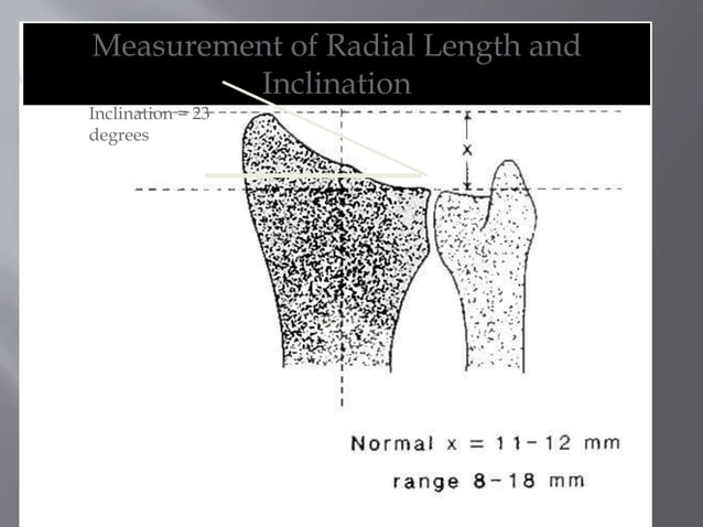 DISTAL END RADIUS FRACTURE | PPTX