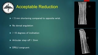 Distal radius fractures | PPTX
