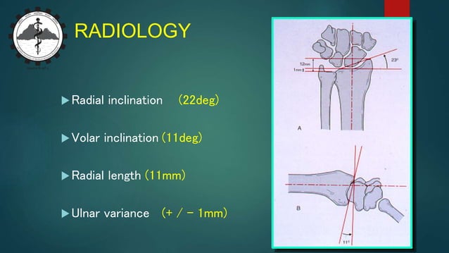 Distal radius fractures | PPTX