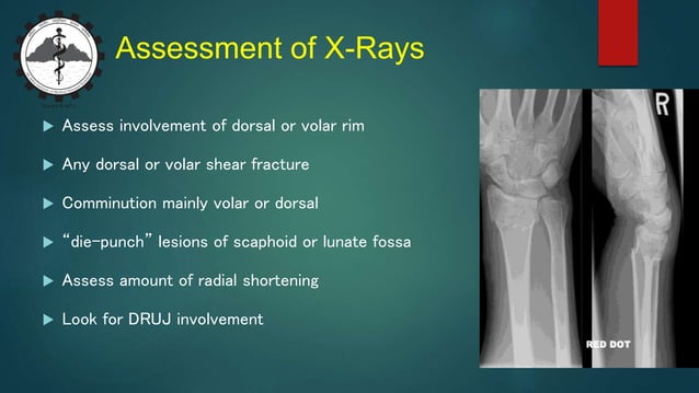 Distal radius fractures | PPTX