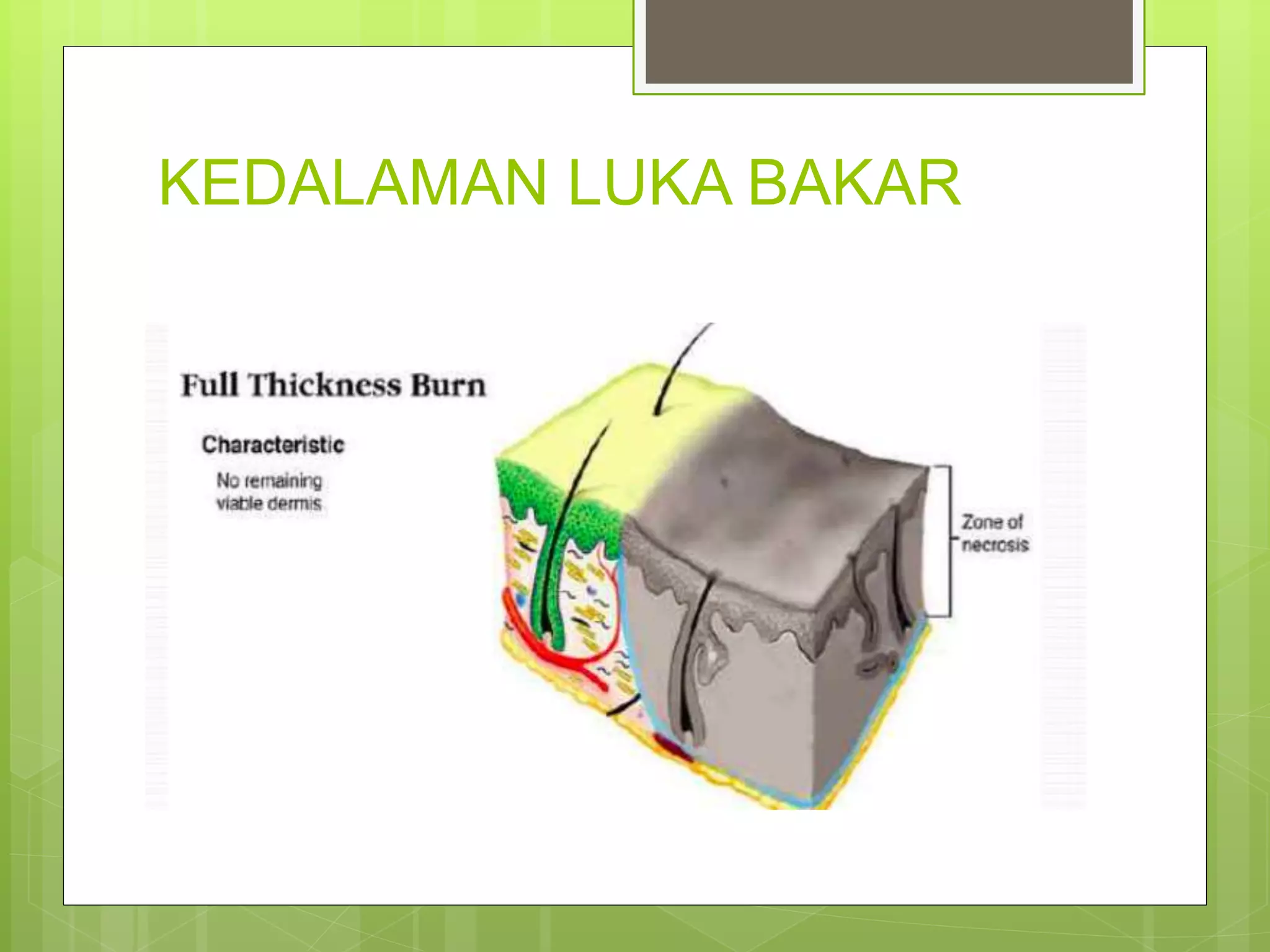 Derajat luka bakar | PPTX