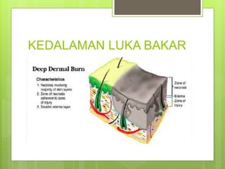 Derajat luka bakar | PPTX