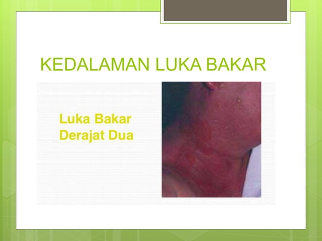 Derajat luka bakar | PPTX