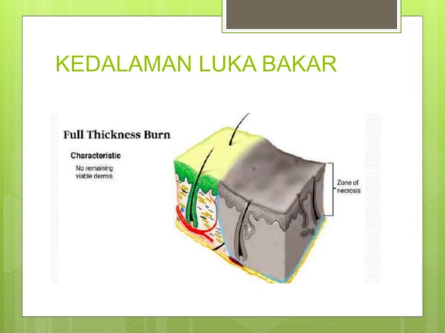 Derajat luka bakar | PPTX