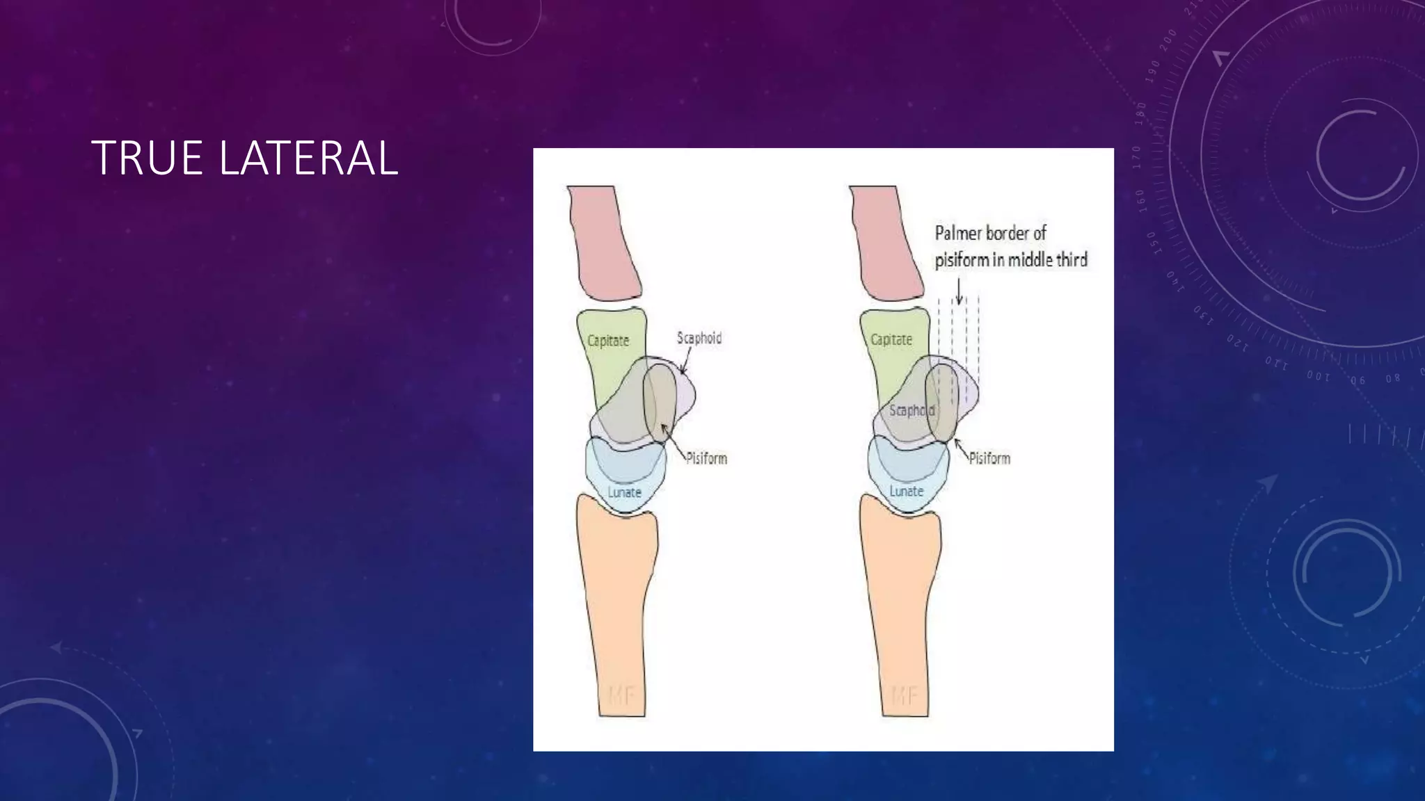 distal end radius fracture | PPTX