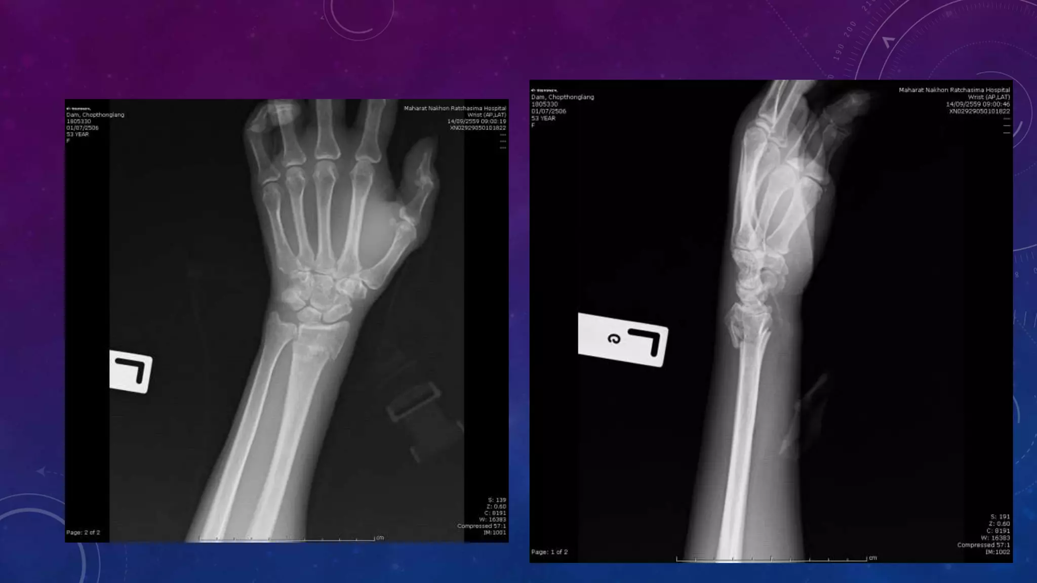 distal end radius fracture | PPTX
