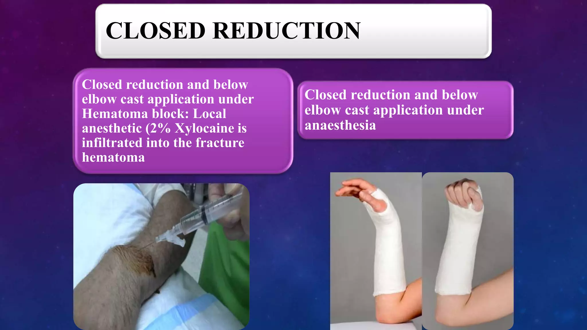 distal end radius fracture | PPTX