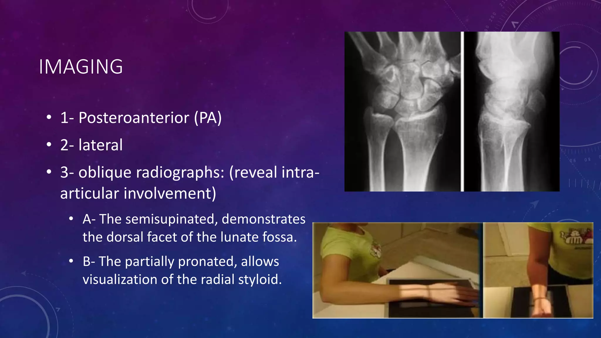 distal end radius fracture | PPTX