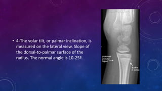 distal end radius fracture | PPTX