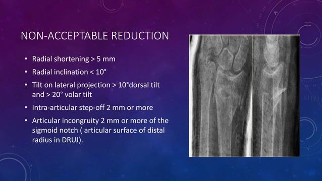 distal end radius fracture | PPTX | Death, Injury, or Military Conflict ...