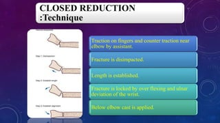 distal end radius fracture | PPTX