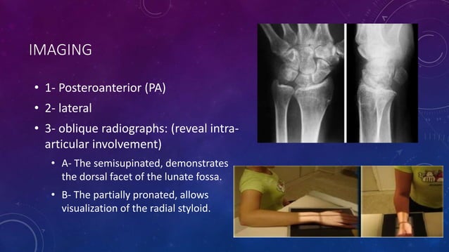 distal end radius fracture | PPTX | Death, Injury, or Military Conflict ...