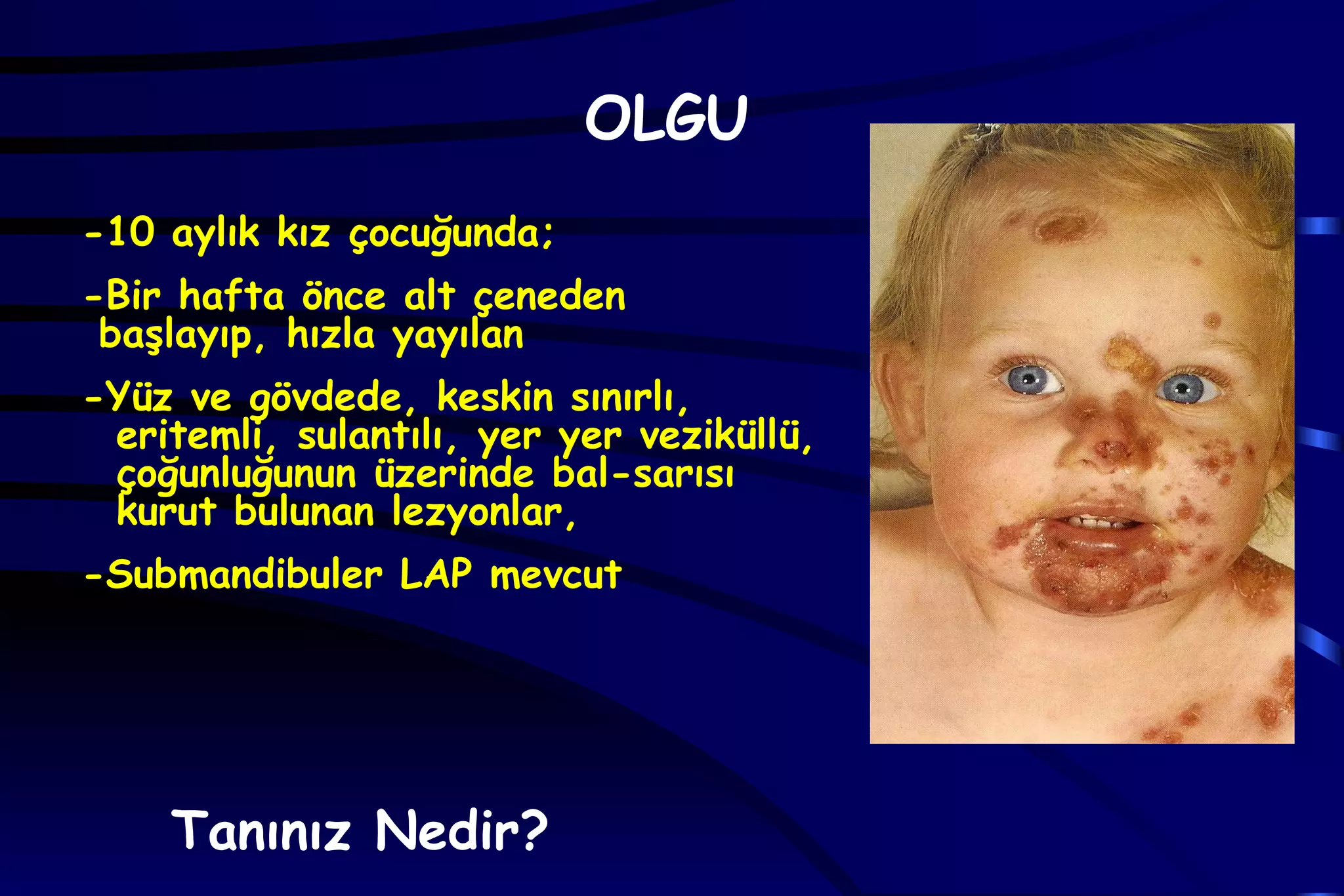 bakterial ve fungal deri enfeksionları | PPT