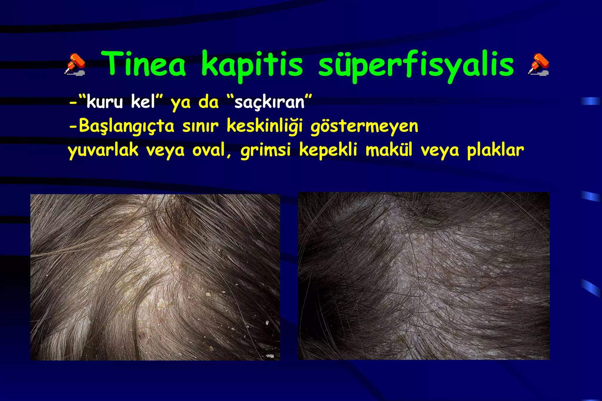 bakterial ve fungal deri enfeksionları | PPT