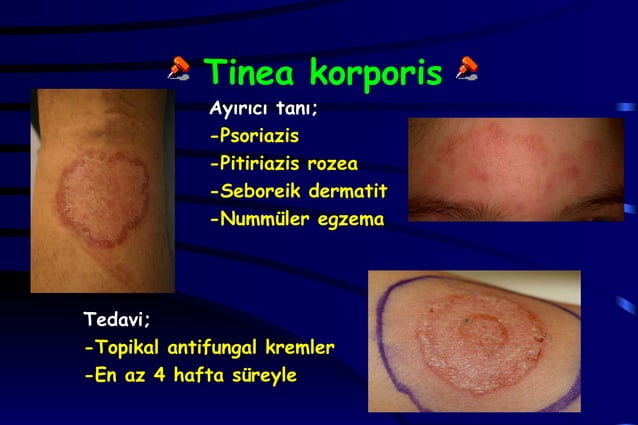 bakterial ve fungal deri enfeksionları | PPT