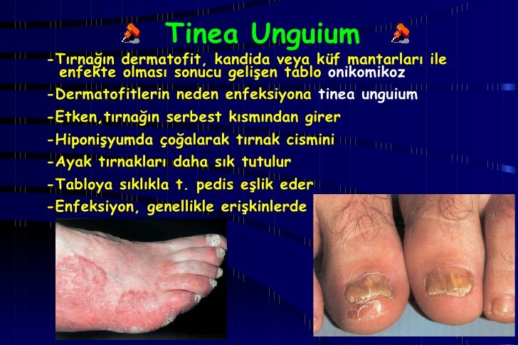 bakterial ve fungal deri enfeksionları