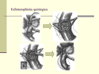 Derivacions bilio digestives (tècnica quirúrgica) | PDF