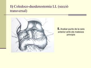 Derivacions bilio digestives (tècnica quirúrgica) | PDF