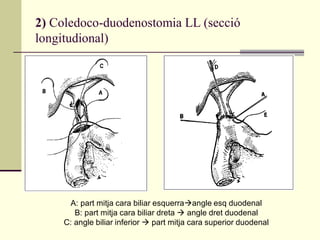 Derivacions bilio digestives (tècnica quirúrgica) | PDF