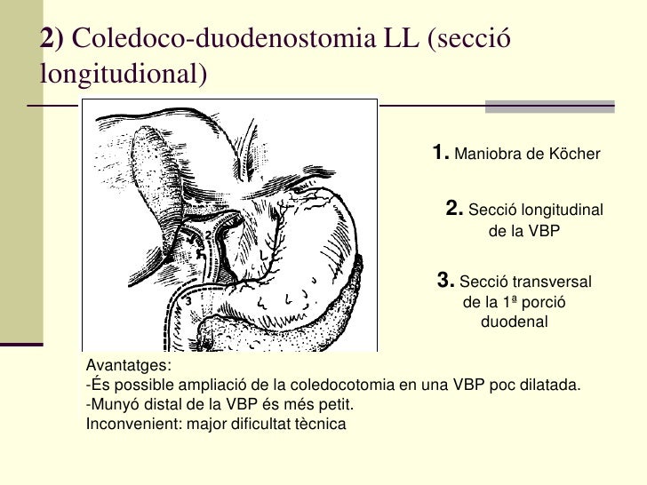 Derivacions bilio digestives (tècnica quirúrgica)