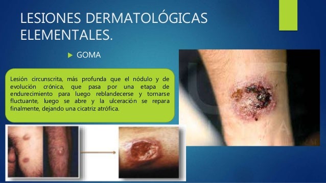 Dermatologia Lesiones elementales