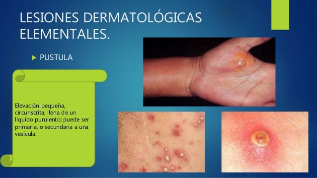Dermatologia Lesiones elementales