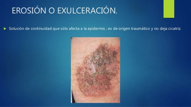 Dermatologia Lesiones elementales